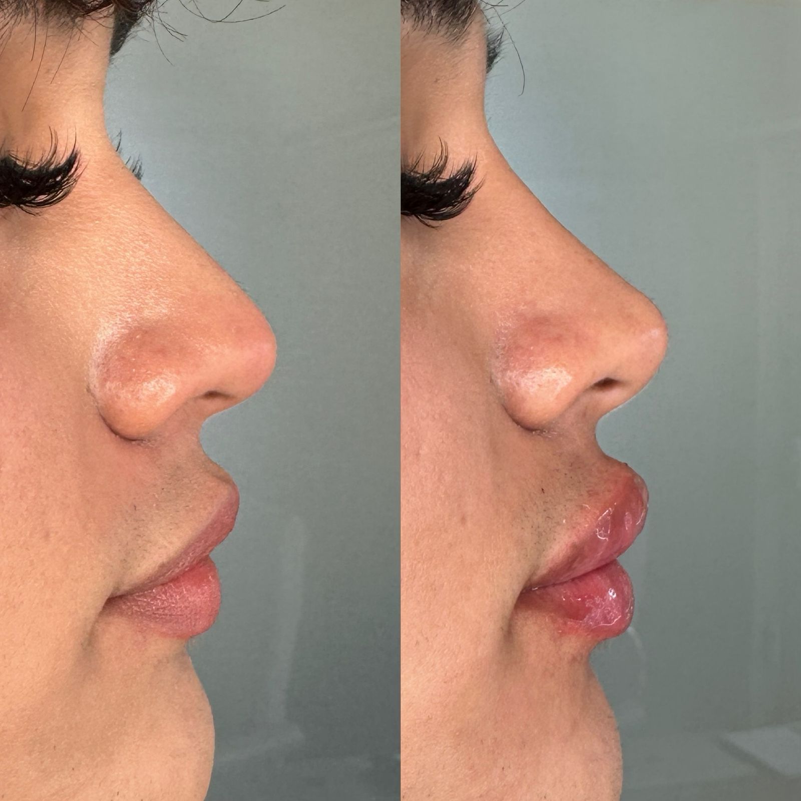 Nose Filler: Moldea tu Nariz sin Cirugía